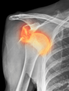 Shoulder Fracture Surgeons Near Me in Elkhart, IN | Orthopedic Shoulder ...