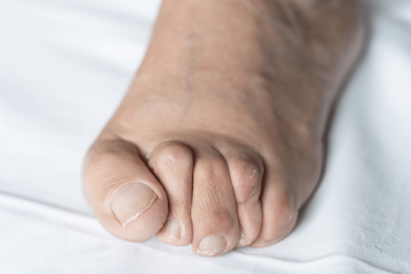 Hammertoe Causes, Symptoms & Treatment | Elkhart Foot Specialists